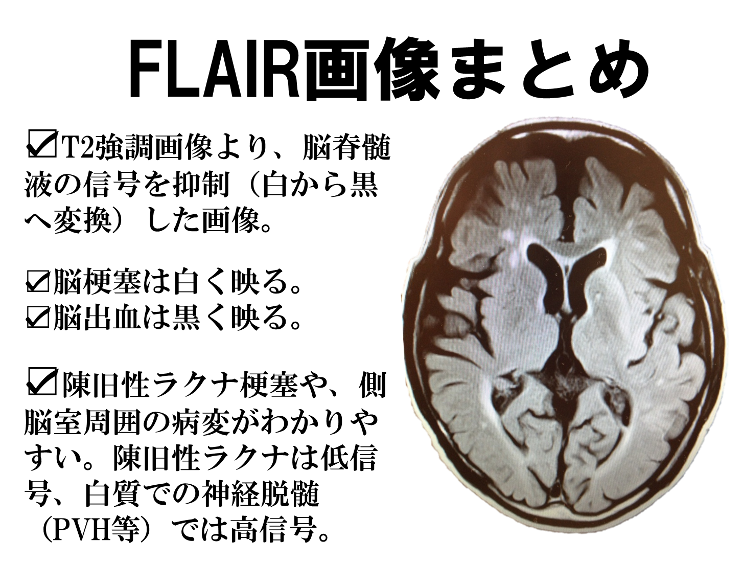 脳画像におけるCT・MRIの見方！！みるべきポイントさえ押さえれば、脳画像は簡単に見れる！！ | リハアイデア