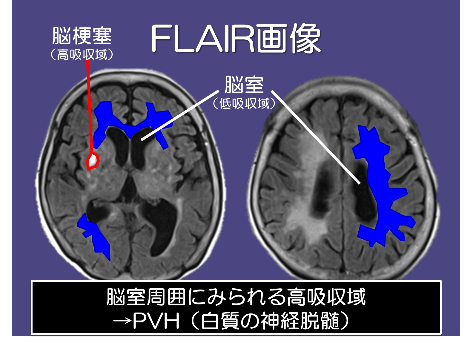 脳画像におけるCT・MRIの見方！！みるべきポイントさえ押さえれば、脳画像は簡単に見れる！！ | リハアイデア