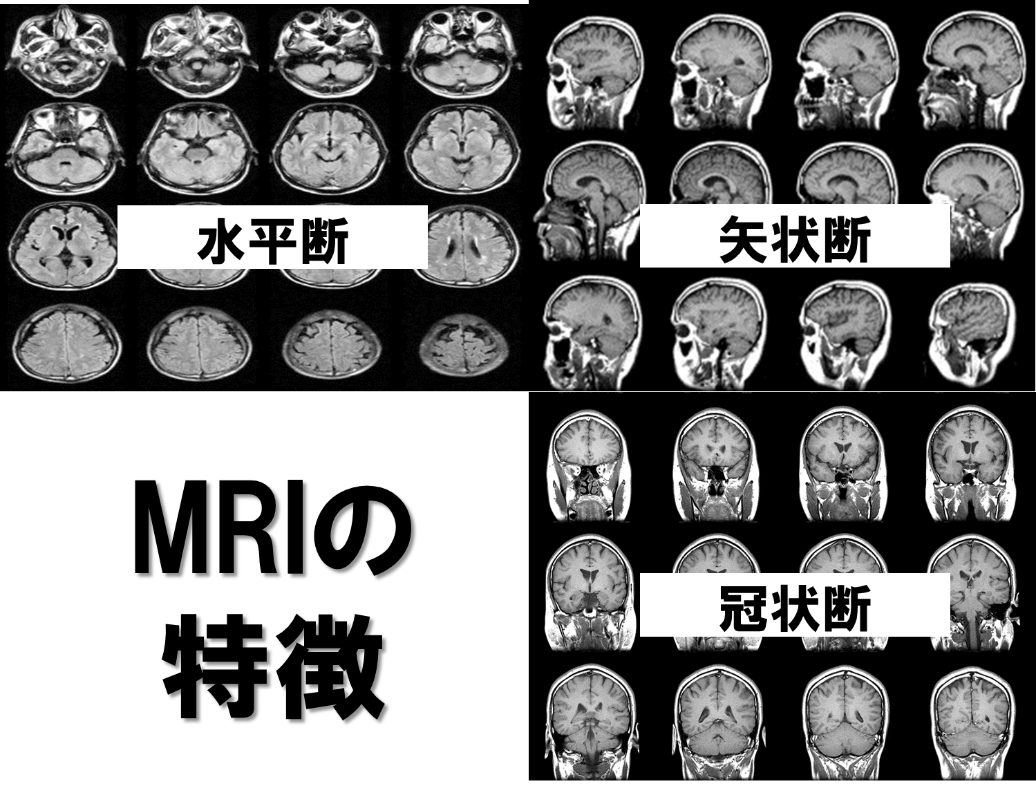 脳画像におけるCT・MRIの見方！！みるべきポイントさえ押さえれば、脳画像は簡単に見れる！！ | リハアイデア