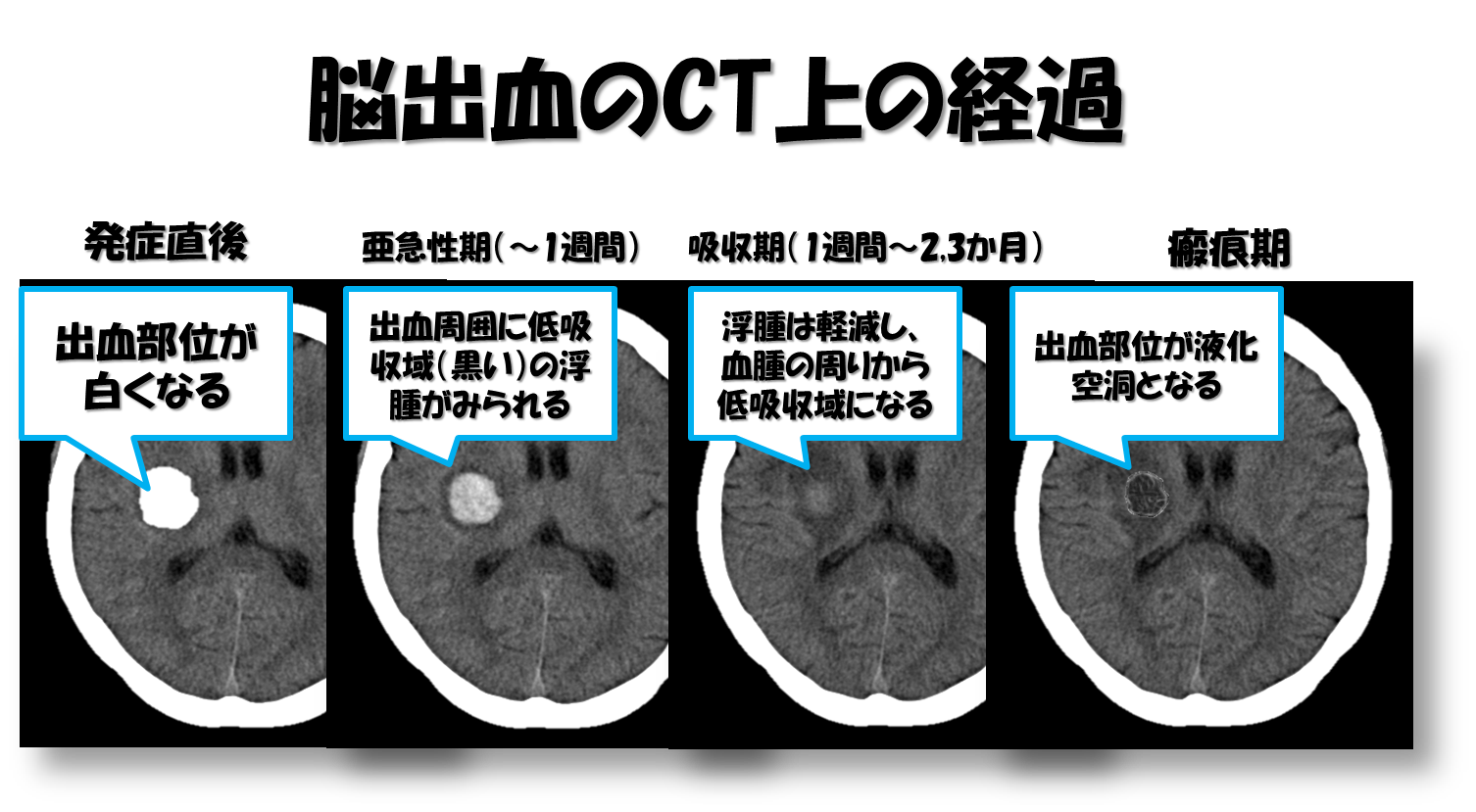 脳画像のCTはここをみろ！！CTの見方から脳出血と脳梗塞の違いまで徹底網羅！ | リハアイデア
