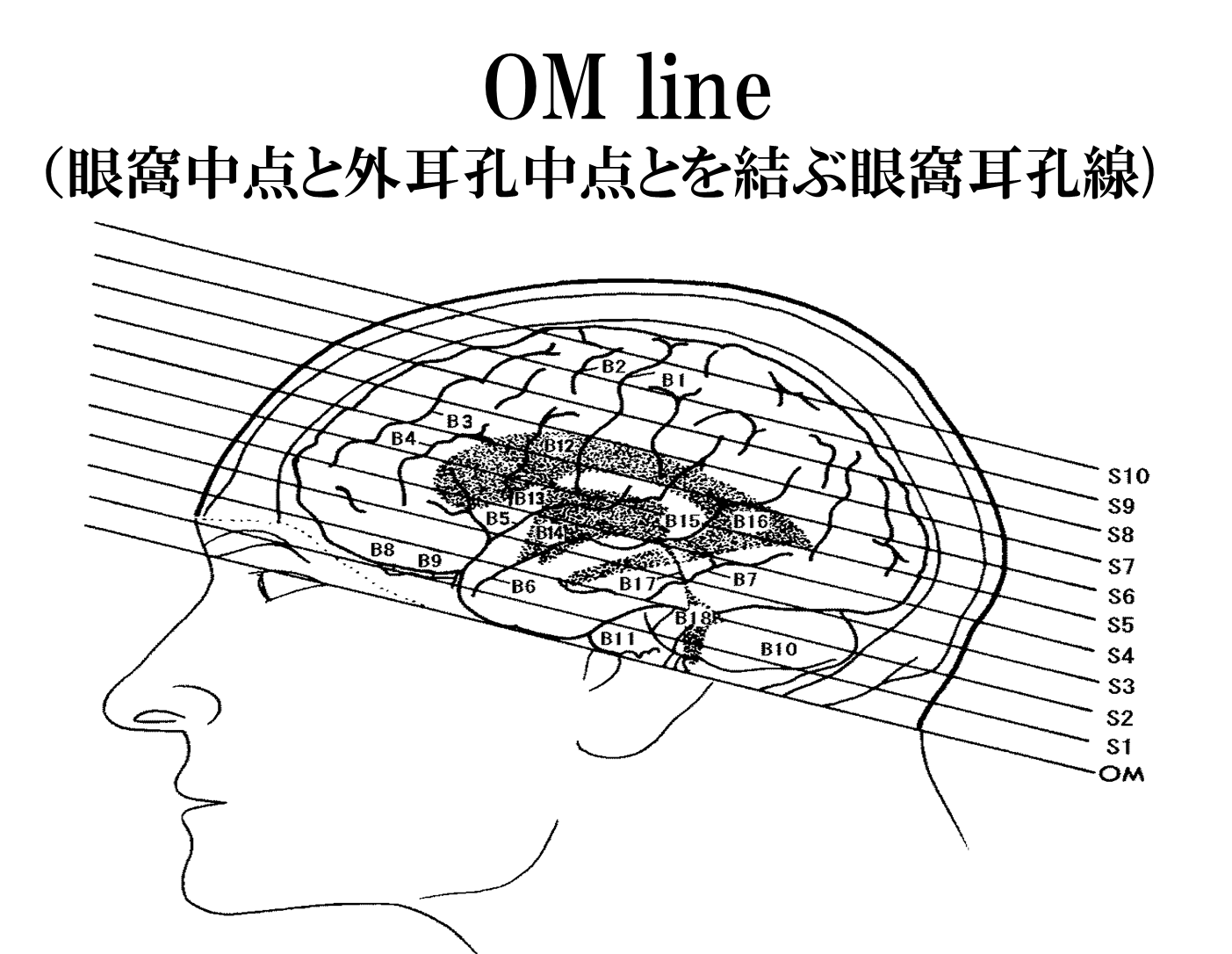 脳画像のCTはここをみろ！！CTの見方から脳出血と脳梗塞の違いまで徹底網羅！ | リハアイデア