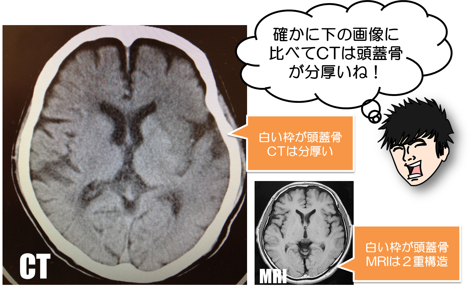 脳画像におけるCT・MRIの見方！！みるべきポイントさえ押さえれば、脳画像は簡単に見れる！！ | リハアイデア